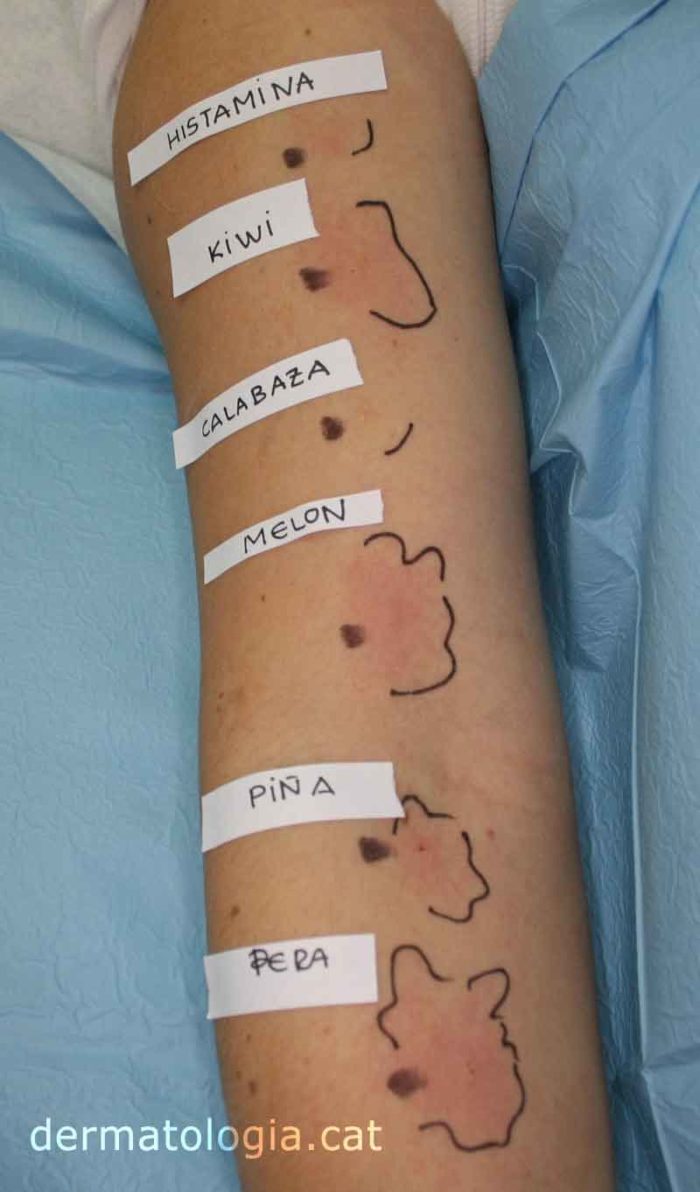 ¿Qué Es El Prick Test? _ Pruebas cutáneas: diagnóstico efectivo de ...